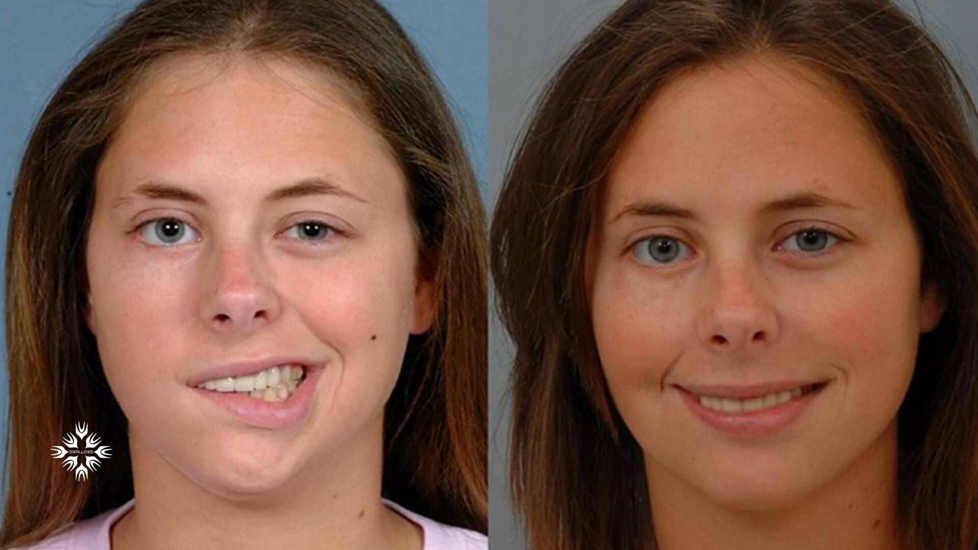 درمان فلج عصب بلز یا فلج بل + علائم، علت و تشخیص - کلینیک یادمان