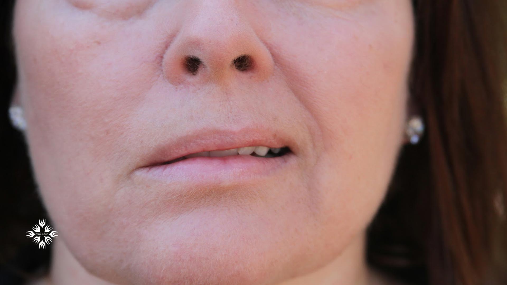 درمان فلج عصب بلز یا فلج بل + علائم، علت و تشخیص - کلینیک یادمان