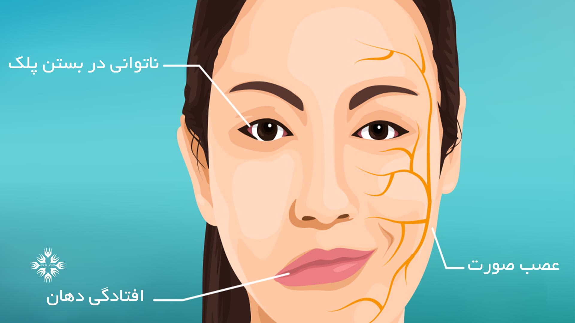 درمان فلج عصب بلز یا فلج بل + علائم، علت و تشخیص - کلینیک یادمان
